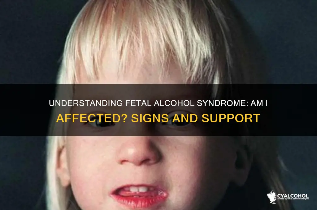 Understanding Fetal Alcohol Syndrome: Am I Affected? Signs And Support ...
