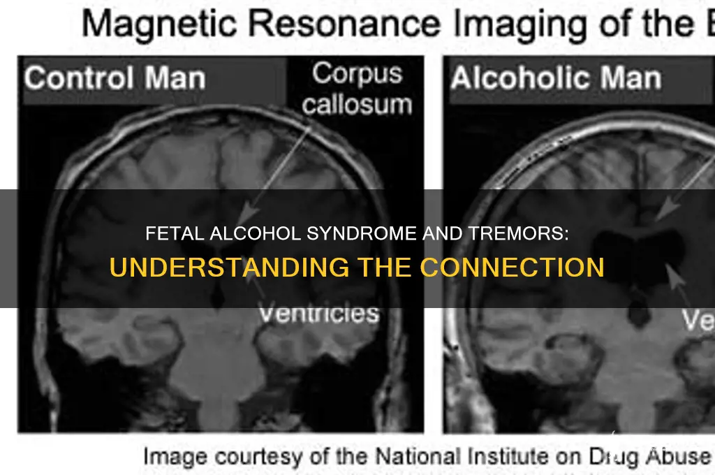 Fetal Alcohol Syndrome And Tremors: Understanding The Connection ...