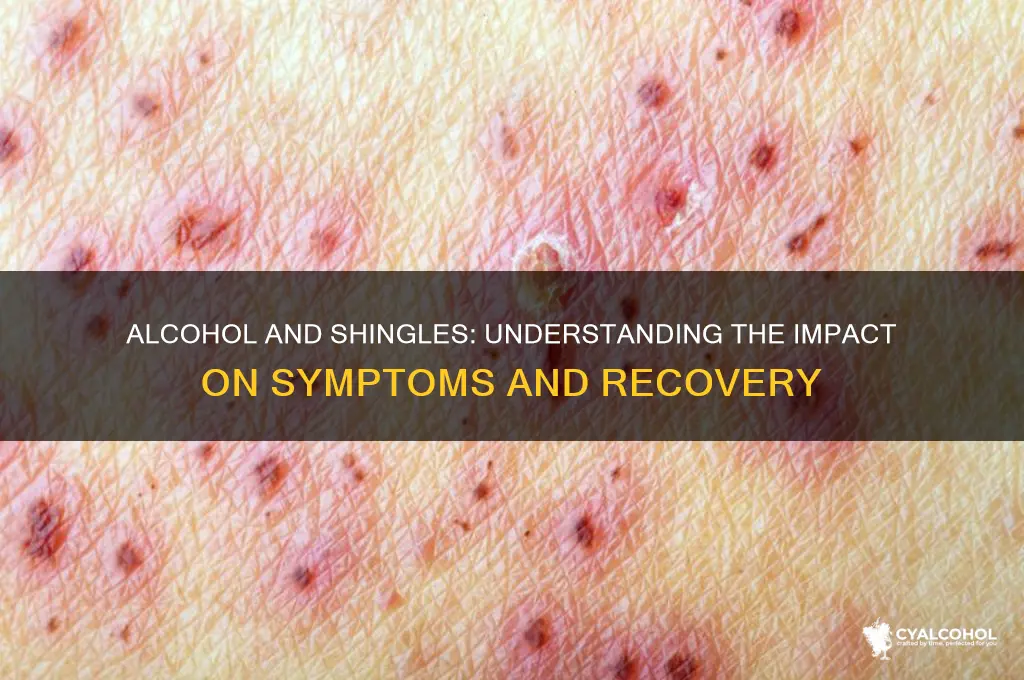 Alcohol And Shingles: Understanding The Impact On Symptoms And Recovery ...