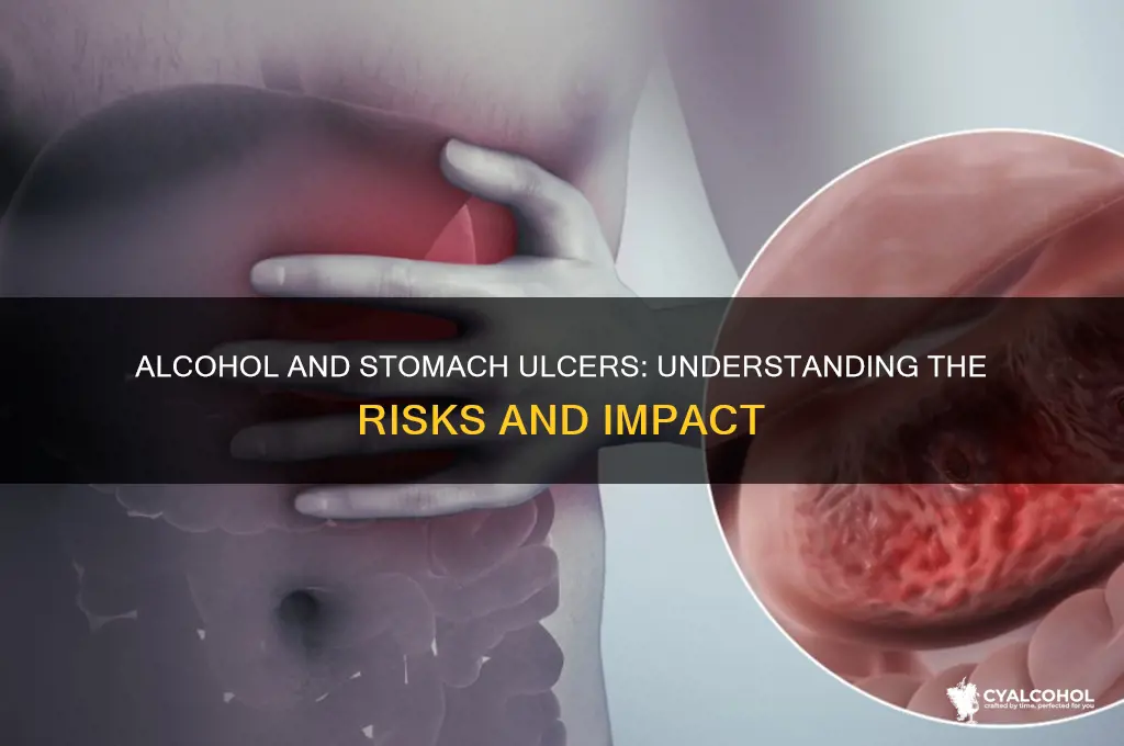 Alcohol And Stomach Ulcers: Understanding The Risks And Impact | CyAlcohol