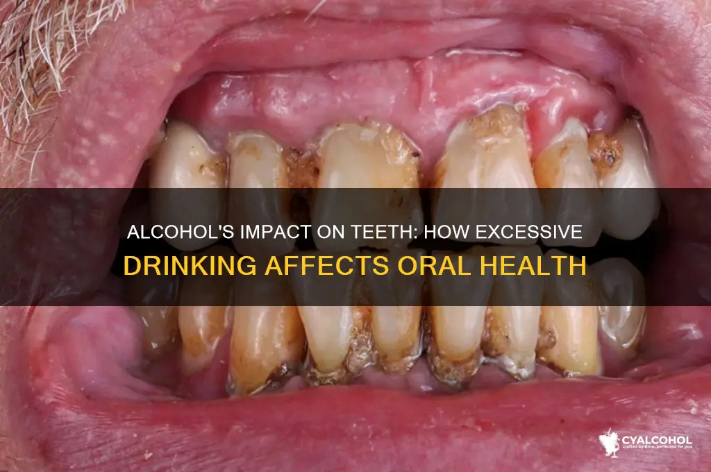 Alcohol's Impact On Teeth: How Excessive Drinking Affects Oral Health ...