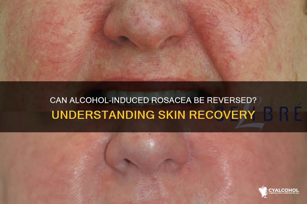 Can Alcohol-Induced Rosacea Be Reversed? Understanding Skin Recovery ...