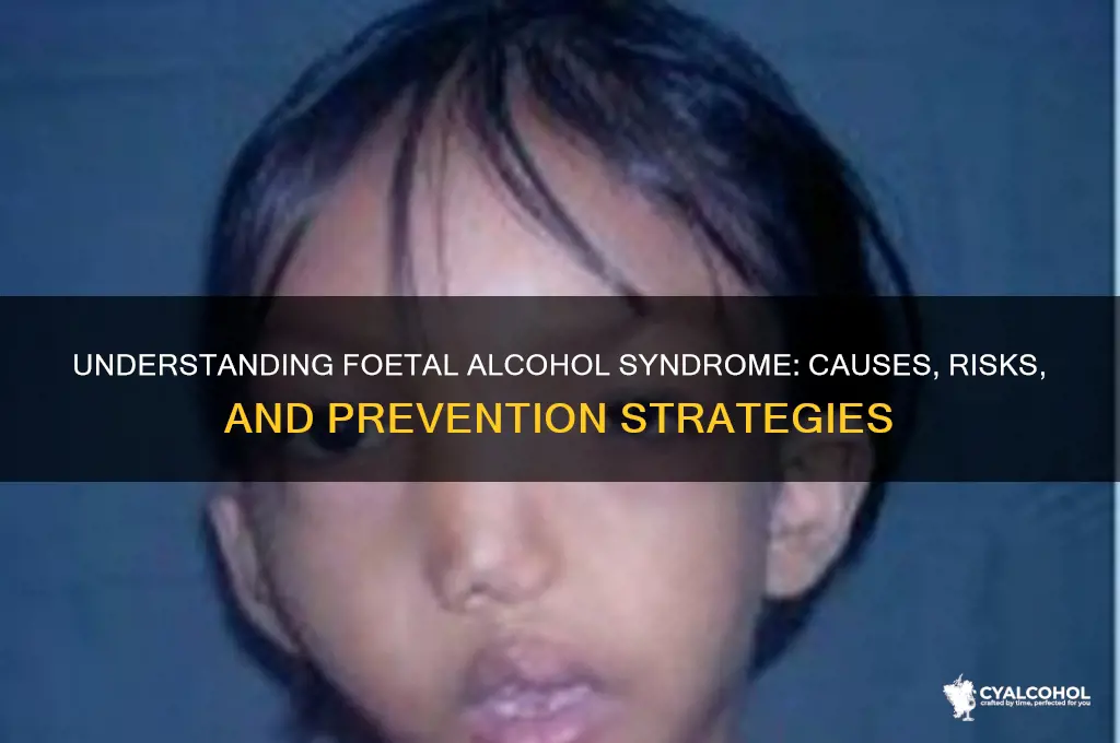 Understanding Foetal Alcohol Syndrome: Causes, Risks, And Prevention ...