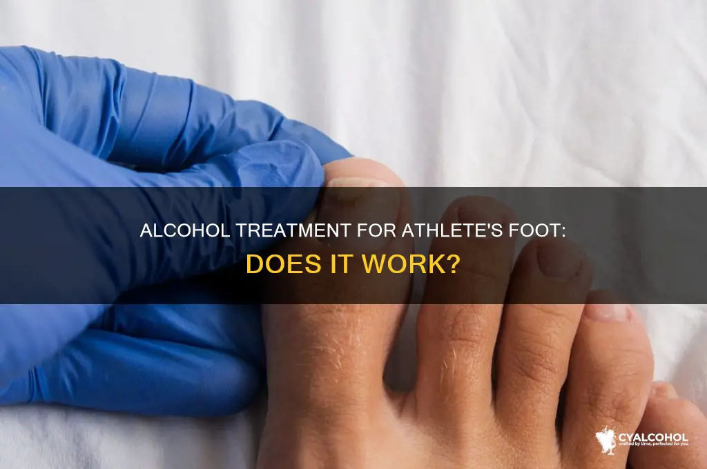 Alcohol Treatment For Athlete's Foot: Does It Work? | CyAlcohol