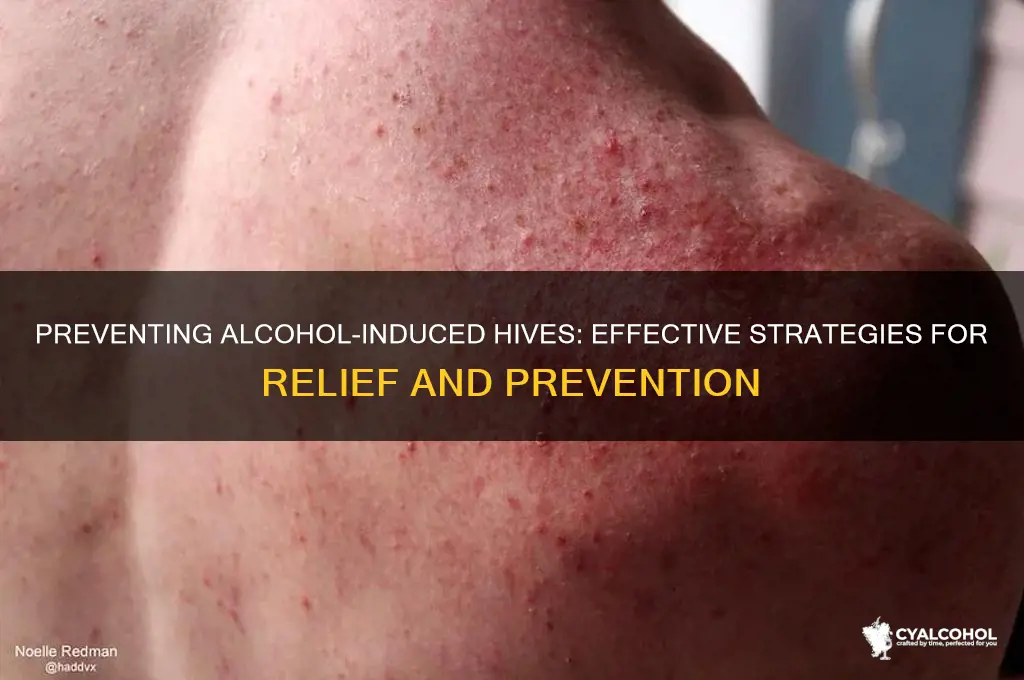 Preventing Alcohol-Induced Hives: Effective Strategies For Relief And ...