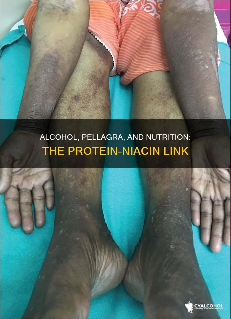Alcohol, Pellagra, And Nutrition: The Protein-Niacin Link | CyAlcohol