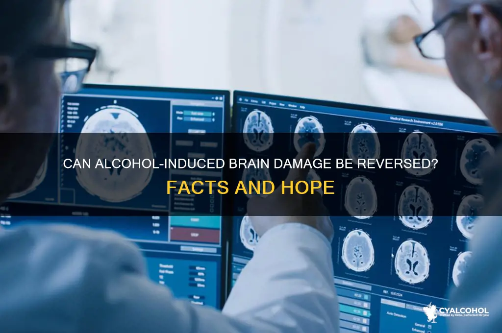 Can Alcohol-Induced Brain Damage Be Reversed? Facts And Hope | CyAlcohol