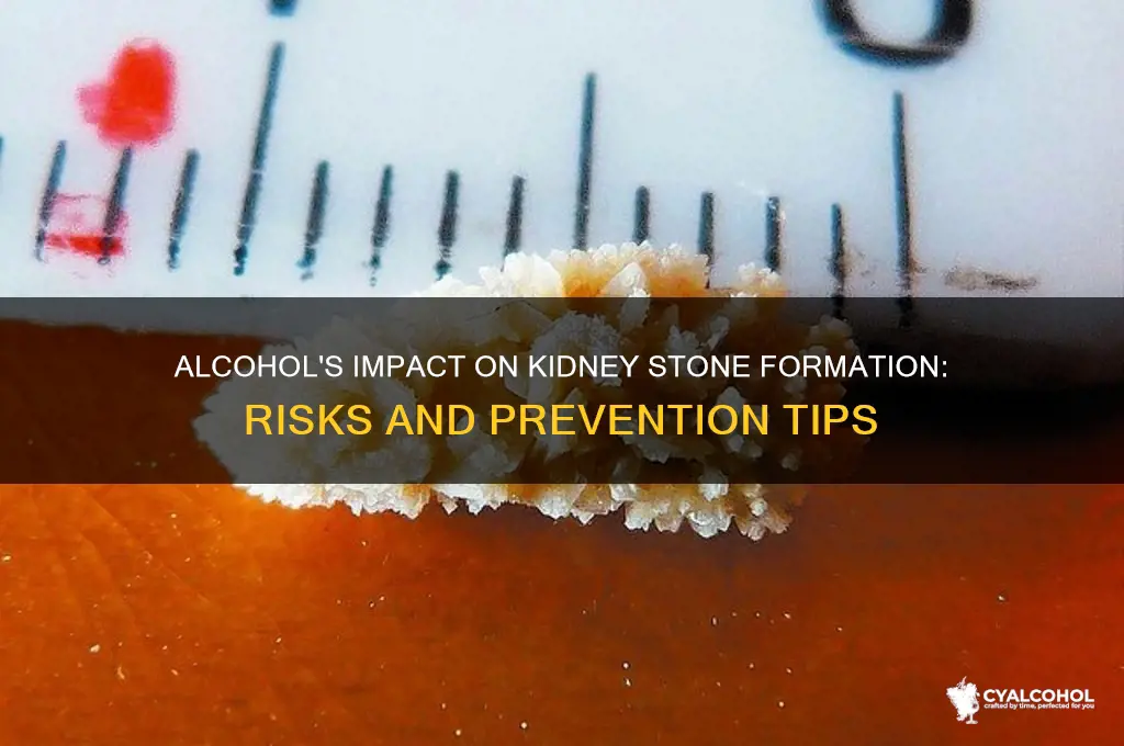 Alcohol's Impact On Kidney Stone Formation: Risks And Prevention Tips ...