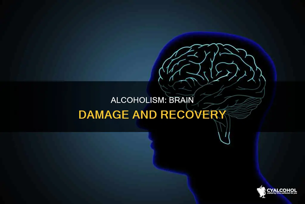 Alcoholism: Brain Damage And Recovery | CyAlcohol