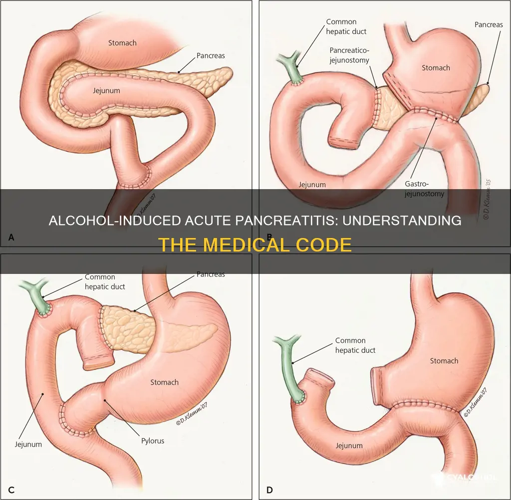Alcohol-Induced Acute Pancreatitis: Understanding The Medical Code ...