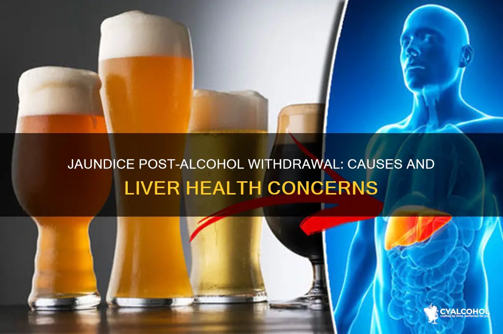 Jaundice Post-Alcohol Withdrawal: Causes And Liver Health Concerns ...