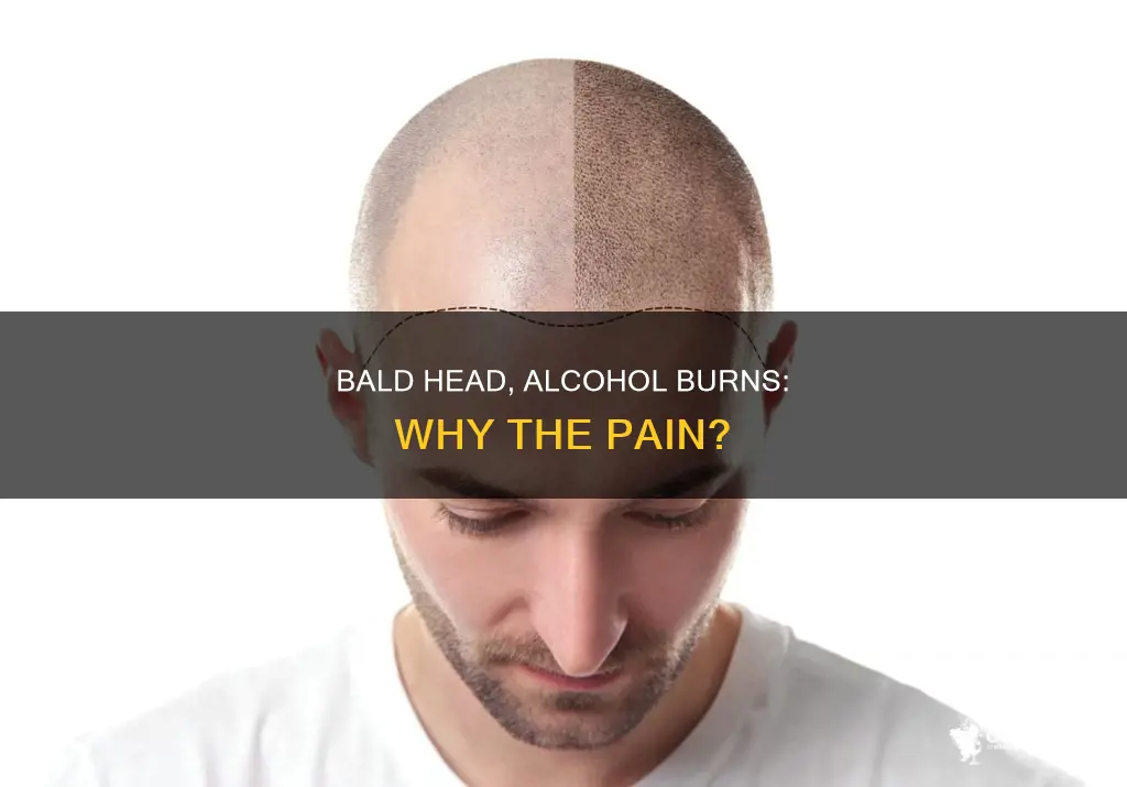 Bald Head, Alcohol Burns: Why The Pain? | CyAlcohol